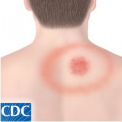 CDC Guidance on Lyme Rash Challenged | WebWire